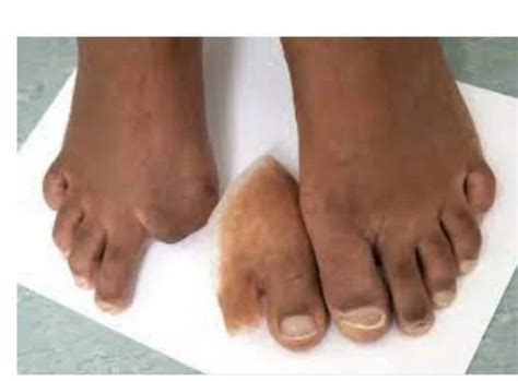 Silicone Toe Prosthesis At Rs 28500 Body Part Silicone Prosthesis In Ramanagara Id