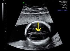 Fetus Developing Body On Ultrasound Flashcards Quizlet