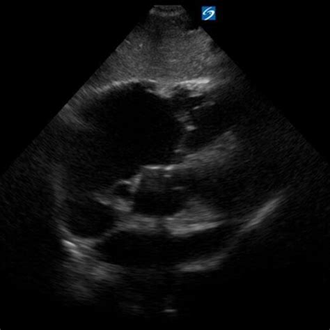 Apical 4 Chamber With Flow Shows Intimal Flap Protruding From The