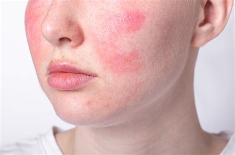 Clindamycin Metronidazole Killing The Bacteria That Cause Acne And By