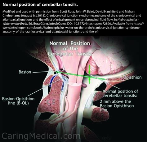 Tonsillar Herniation Radiology Journal Of Korean Neurosurgical Society