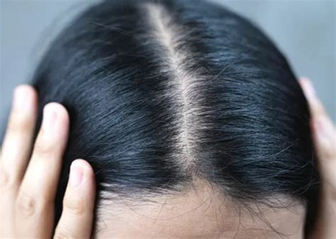 Scalp Pigmentation Frisco Tx Geneva Med Spa