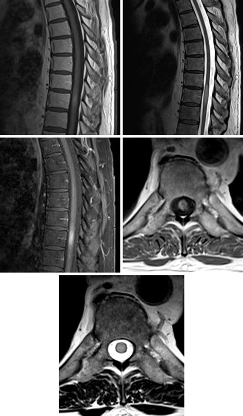 Transverse Myelitis The Neurosurgical Atlas