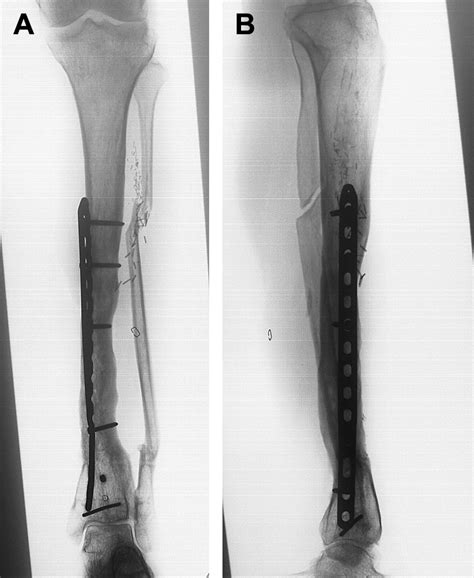Treatment Of Large Segmental Bone Defects With Reamer Irrigator Aspirator Bone Graft Technique