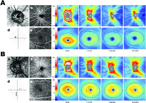 Representative Cases Of Optic Neuritis Patients Depending On The