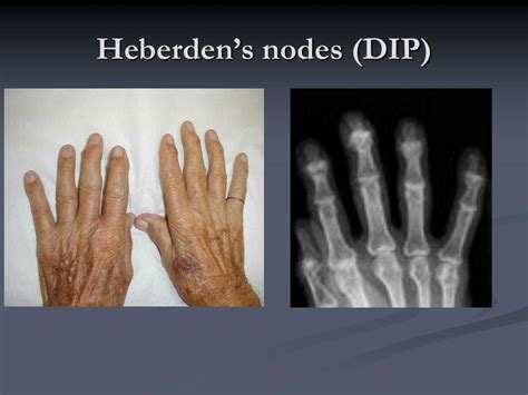 Heberden S Nodes Fingers