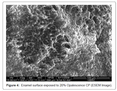 Dentistry Enamel Surface Exposed