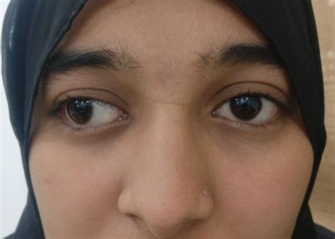 Lazy Eye Treatment In Adults RevitalVision Eye Solutions