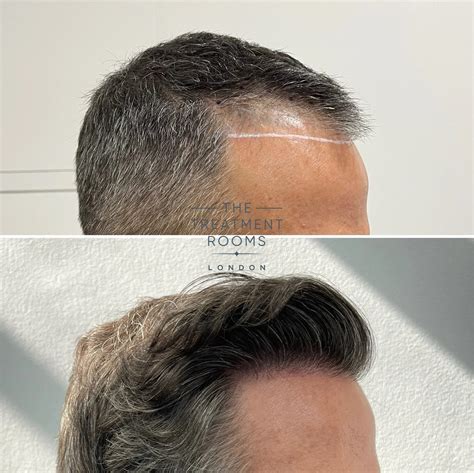 Hair Transplant Clinic Uk Book With Treatment Rooms London