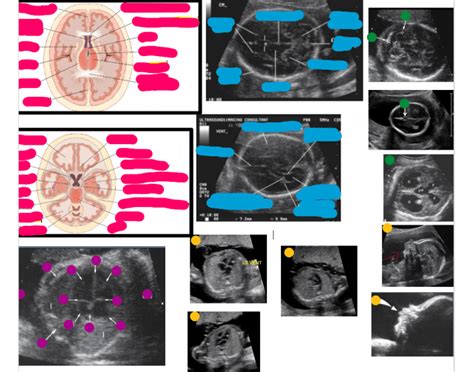 Obgyn Mega Final Study Guide Abnormal 1 Trimester Quiz