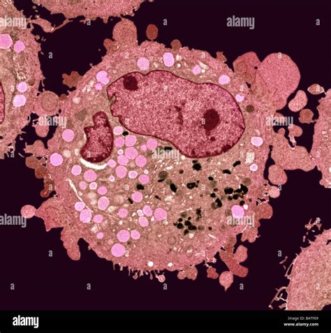 Carcinoma Cell Coloured Transmission Electronmicrograph Tem A