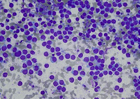 Figure 1 From Cytology Of Undifferentiated Round Cell Sarcomas Of Bone And Soft Tissue Ewing