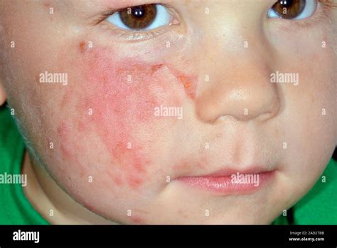 Cellulitis Of The Face Close Up Of Cellulitis Affecting The Cheek Of A