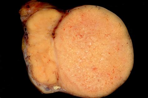 Tumor Mass Cell Tumor