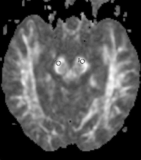 Diffusion Tensor Mr Imaging Of Corticospinal Tract In Amyotrophic