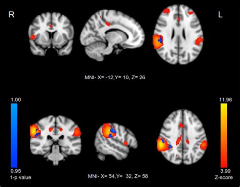 Increased Resting State Functional Connectivity Rsfc In Central