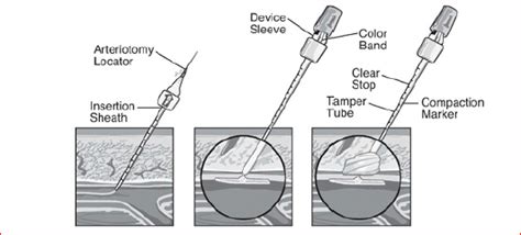 What Are The Types Of Vascular Closure Devices And Indications Of Using