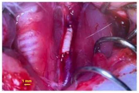 一种人工血管材料及利用其制备的无涂层式一体化抗凝血小口径人工血管 Cn115845147b 专利顾如