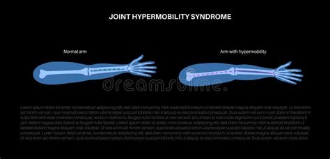 Joint Hypermobility Poster Stock Illustration Illustration Of Joint