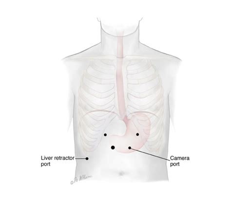 Minimally Invasive Esophagectomy Baylor Medicine
