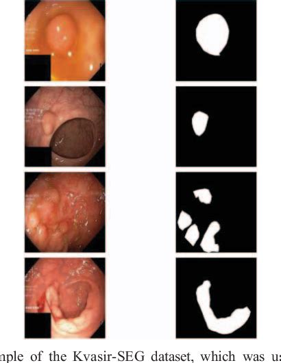 Figure 2 From Towards Real Time Polyp Segmentation During Colonoscopy Using An Efficientnet