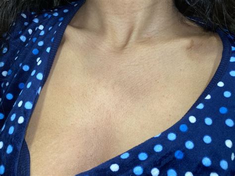Tiny Bumps On Chest What Is This Any Help Racne