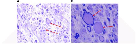 A And B Giant Axons With Aberrant Neurofilament Immunostaining On