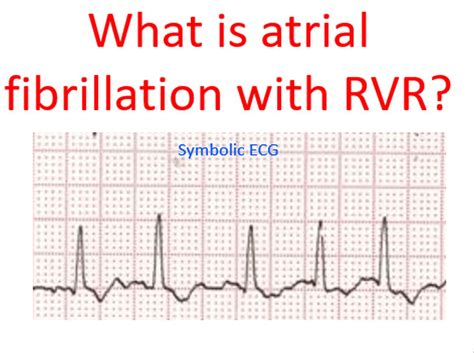 Ventricular Fibrillation Meaning Ventricular Fibrillation Youtube