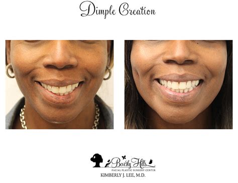 Dimple Creation Before And After Photos Dr Kimberly Lee