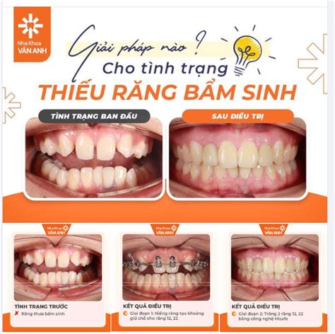 Giải pháp nào cho người thiếu răng bẩm sinh