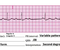 Ecg Chapter 8 Heart Block Dysrhythmias Flashcards Quizlet