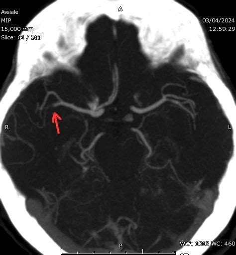 A 90 Year Old Woman Presented To The Emergency Department At 12 30 With