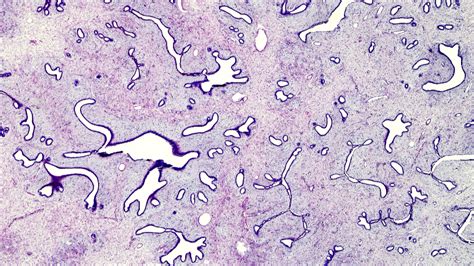 Aussie Scientists Discover Biomarkers Of Hard To Diagnose Breast Tumor