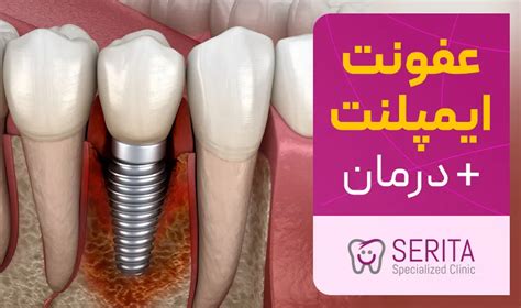 علائم عفونت ایمپلنت دندان روش های درمان پیشگیری