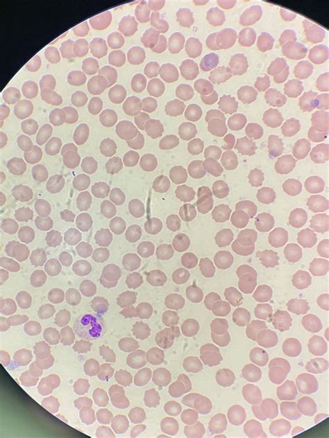 Echinocytes Red Blood Cells That Have A Spiky Shape Resembling
