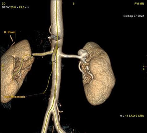 How To Manage Distal Renal Artery Aneurysm Paris Vascular Insights