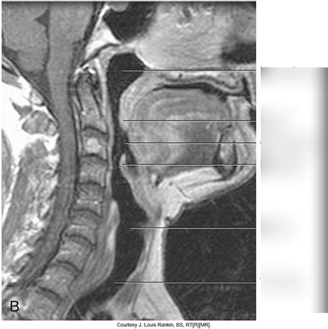 Mri Slice Diagram Quizlet