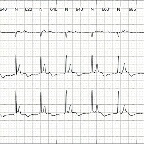 Heart Rate Unmasking After Decrease Heart Rate Download Scientific