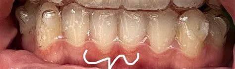 Receding Gums R Dentists