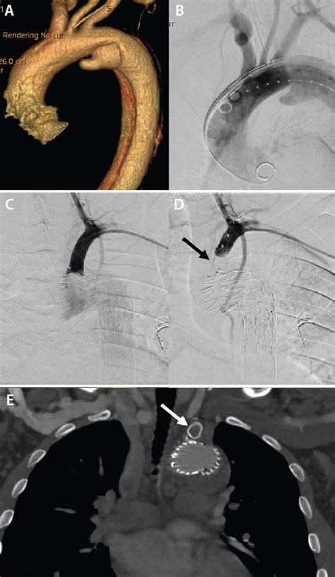 Advances In Plug Technology Endovascular Today