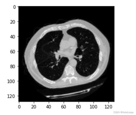 卷积神经网络 3d医疗影像识别cnn 卷积神经网络处理 医疗数据 Csdn博客