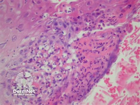 Dermnet® Blastomycosis Like Pyoderma Pathology Image