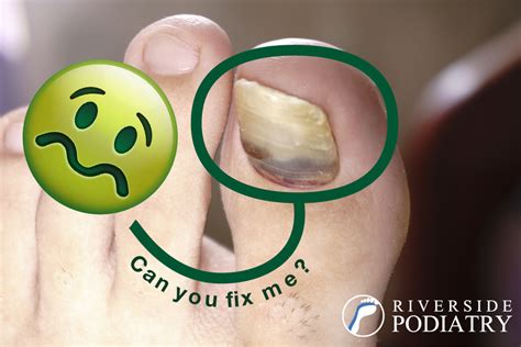 Thickened Toenails Riverside Podiatry