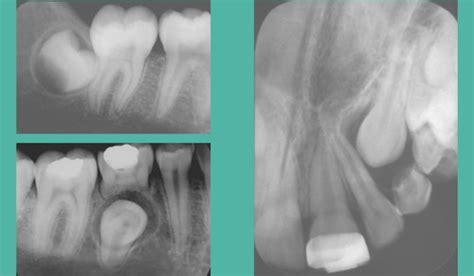 Pericoronal Lesions Flashcards Quizlet