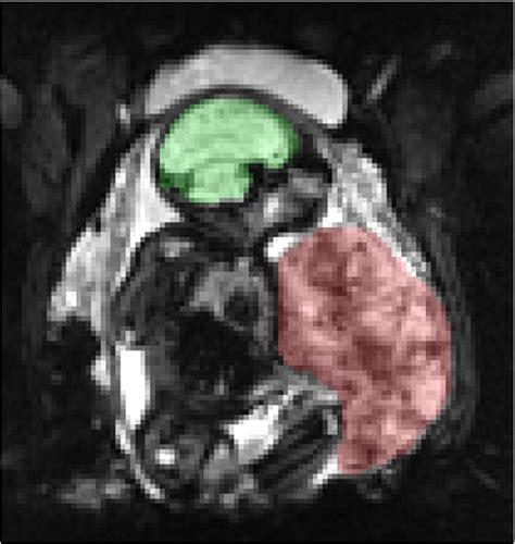 Robust Preprocessing For Stimulus Based Functional Mri Of The Moving Fetus