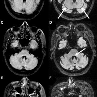 Axial Fluid Attenuated Inversion Recovery FLAIR Images Of Patient 1