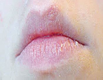 Rash On My Upper Lips Lipstutorial Org
