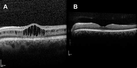 X Linked Retinoschisis For Patients Gene Vision