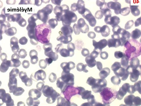 Dacryocyte Comprendre Son Importance Dans Le Diagnostic Des Maladies