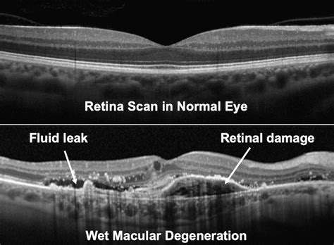 Wet Macular Degeneration Oct